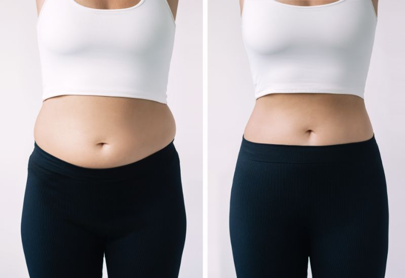 Liposuction Recovery Process - The Full Guide