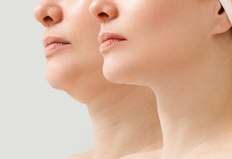 Discover Different Types of Facelifts | Facelift Techniques